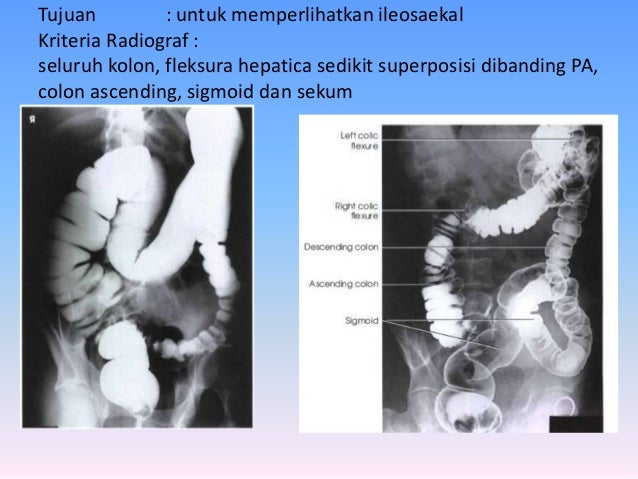 Teknik Pemeriksaan Radiografi Colon In Loop (CIL)