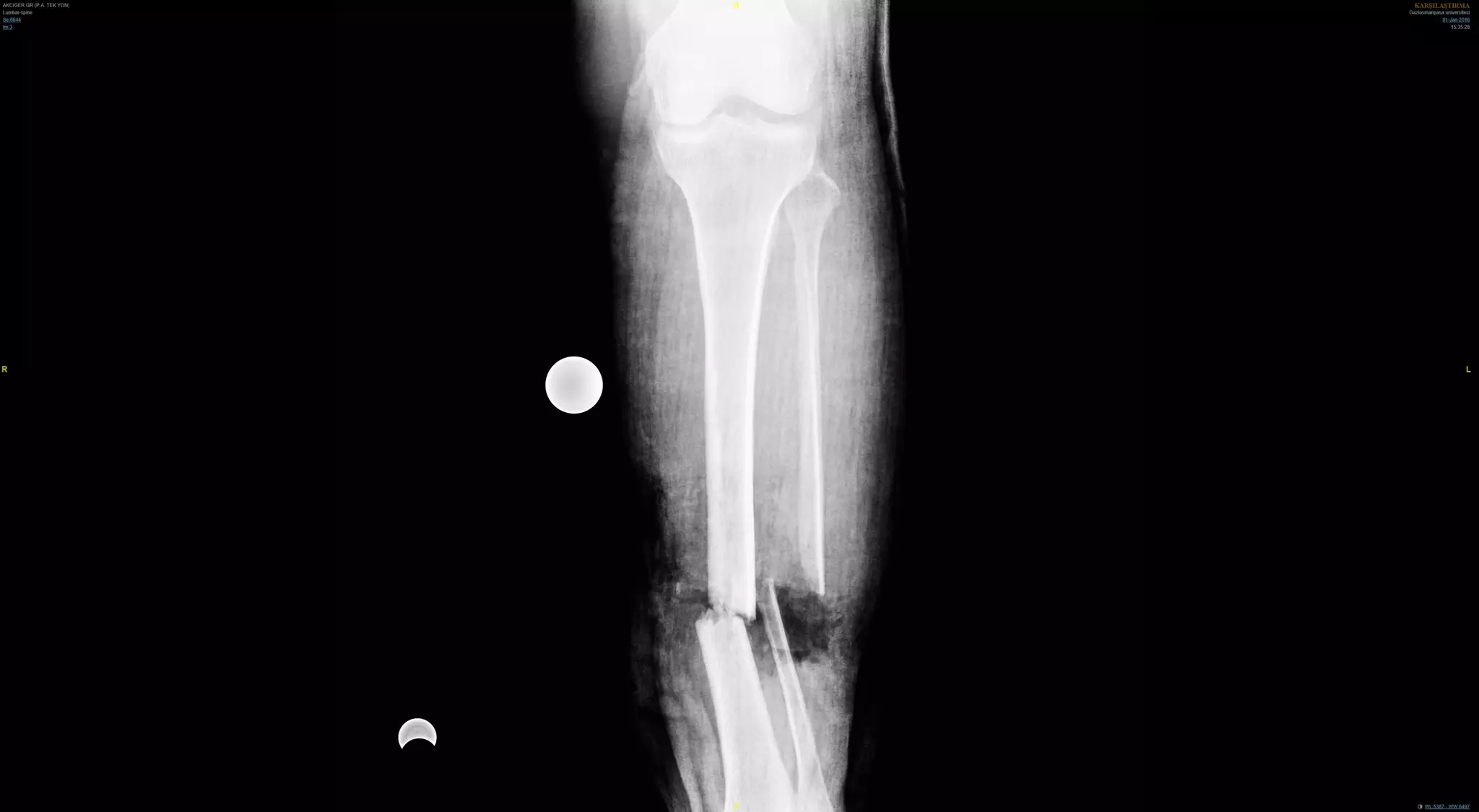 femur tibia fibula | PDF