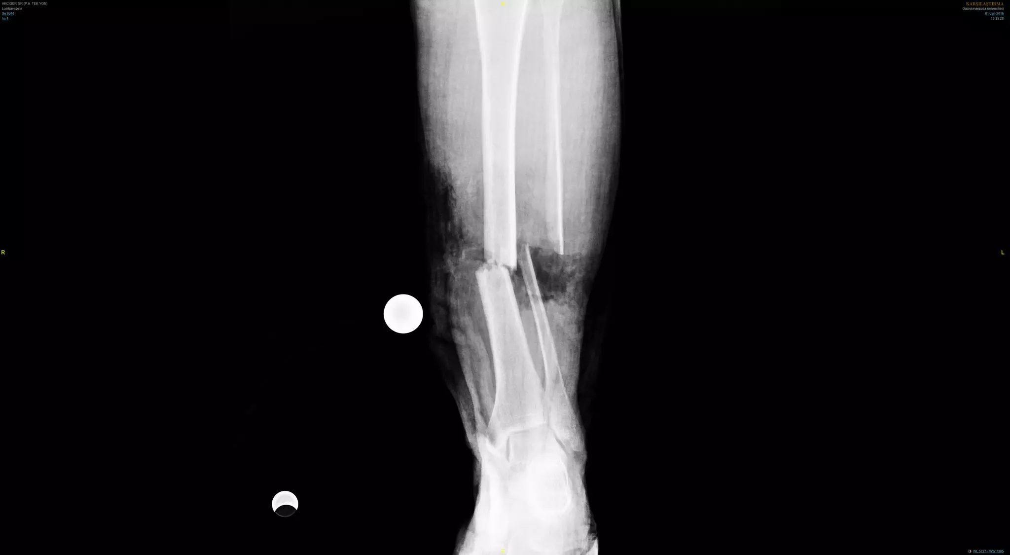 femur tibia fibula | PDF