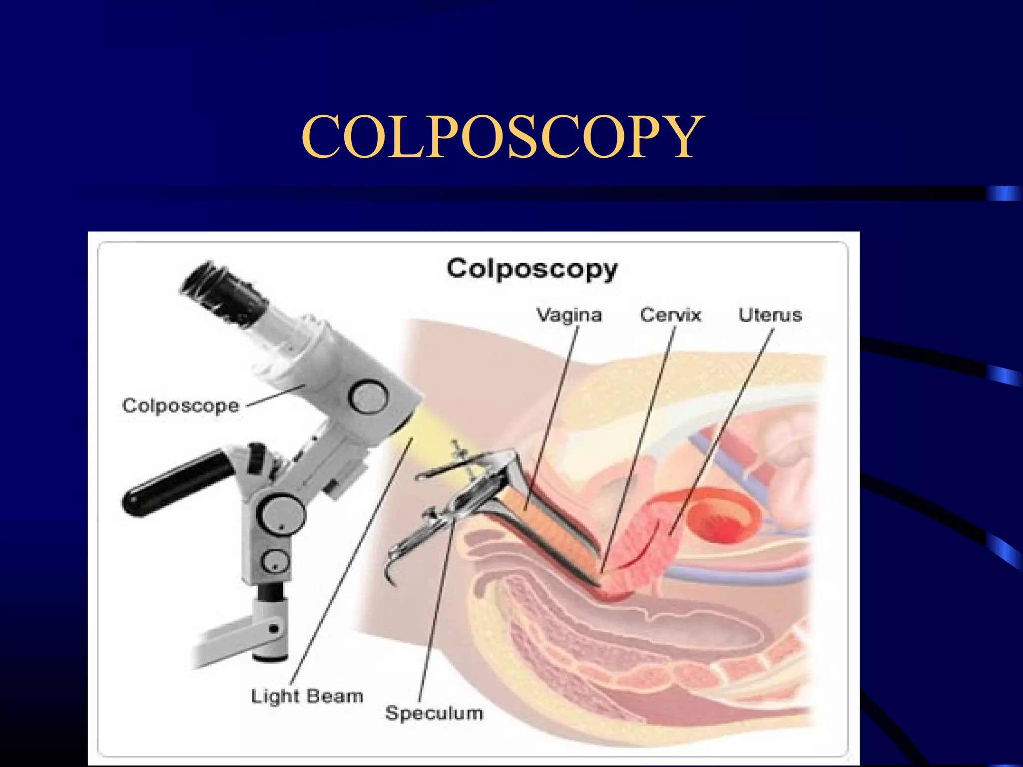 Cinandcancer Cervix Undergraduate Ppt
