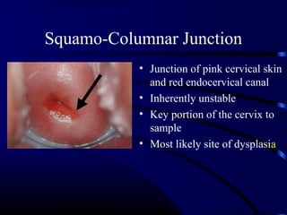 Cin&cancer cervix undergraduate | PPT
