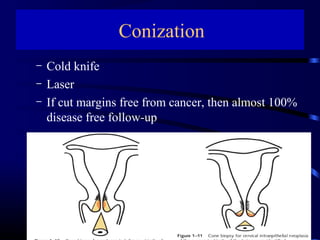 Cin&cancer cervix undergraduate | PPT