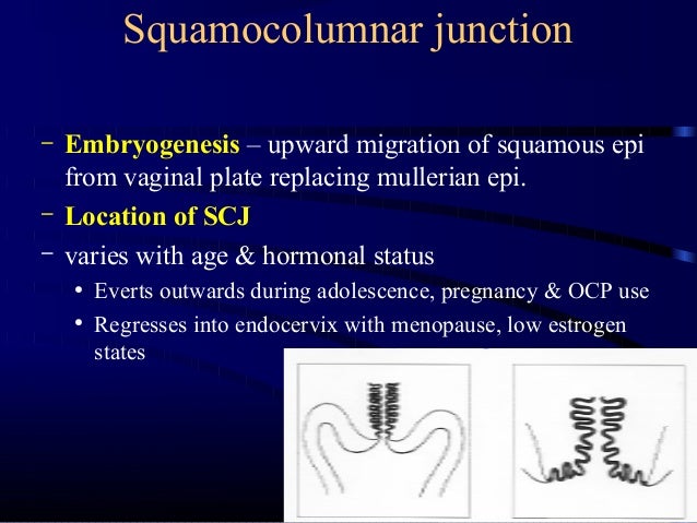 Ectropion Cervical Squamocolumnar Junction Cin