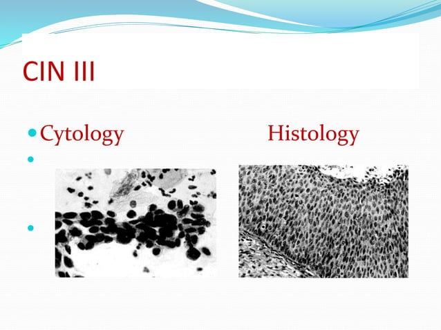 preinvasive lesion of cervix and management ,quick revise tool | PPT