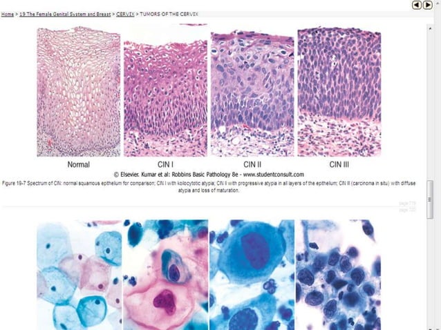 preinvasive lesion of cervix and management ,quick revise tool | PPT