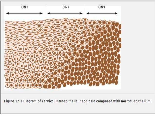 preinvasive lesion of cervix and management ,quick revise tool | PPT