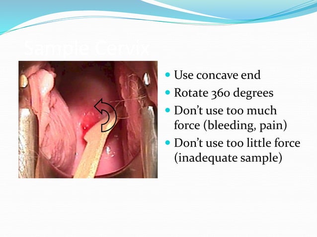 preinvasive lesion of cervix and management ,quick revise tool | PPT