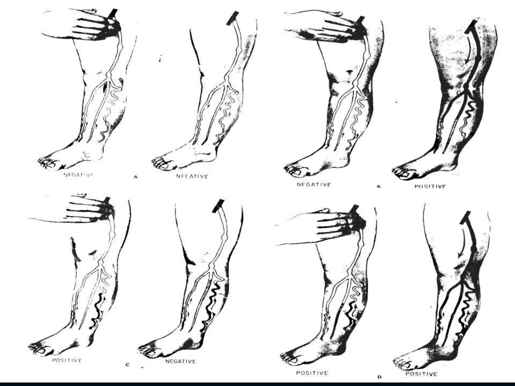 varicose veins- Cinical Features & Examination | PPT