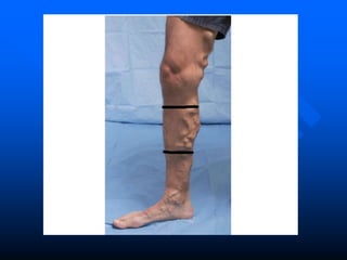 varicose veins- Cinical Features & Examination | PPT