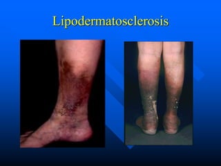 varicose veins- Cinical Features & Examination | PPT
