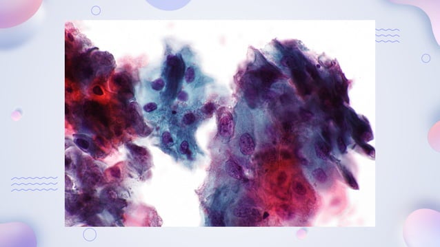 HPV, CIN, PAP SMEAR - description process guidelines etc | PPTX