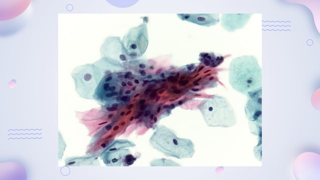 HPV, CIN, PAP SMEAR - description process guidelines etc | PPTX