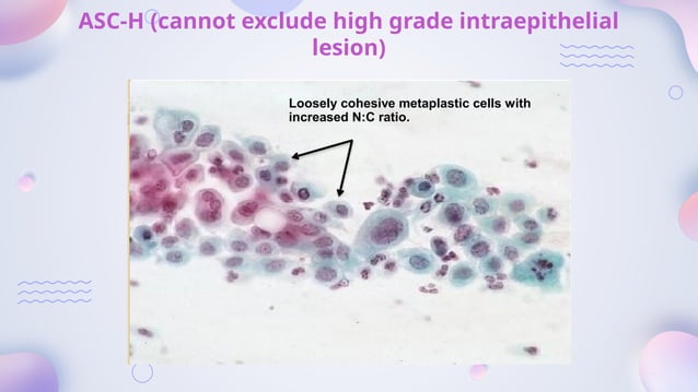HPV, CIN, PAP SMEAR - description process guidelines etc | PPTX