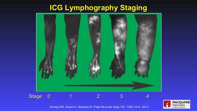 Surgical treatment of secondary lymphoedema—algorythimic approach at