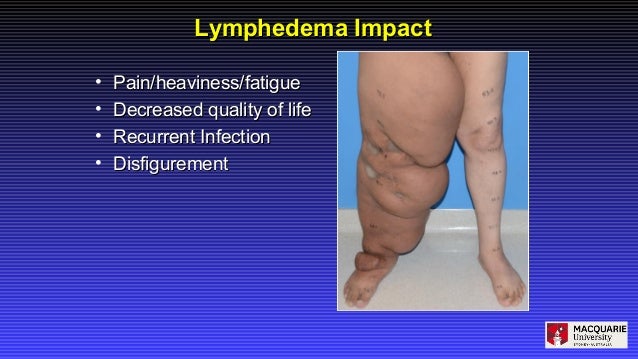 Surgical treatment of secondary lymphoedema—algorythimic approach at
