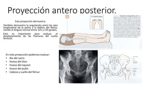 FRACTURA DE LA CINTURA PÉLVICA Y FÉMUR PROXIMAL | PPTX