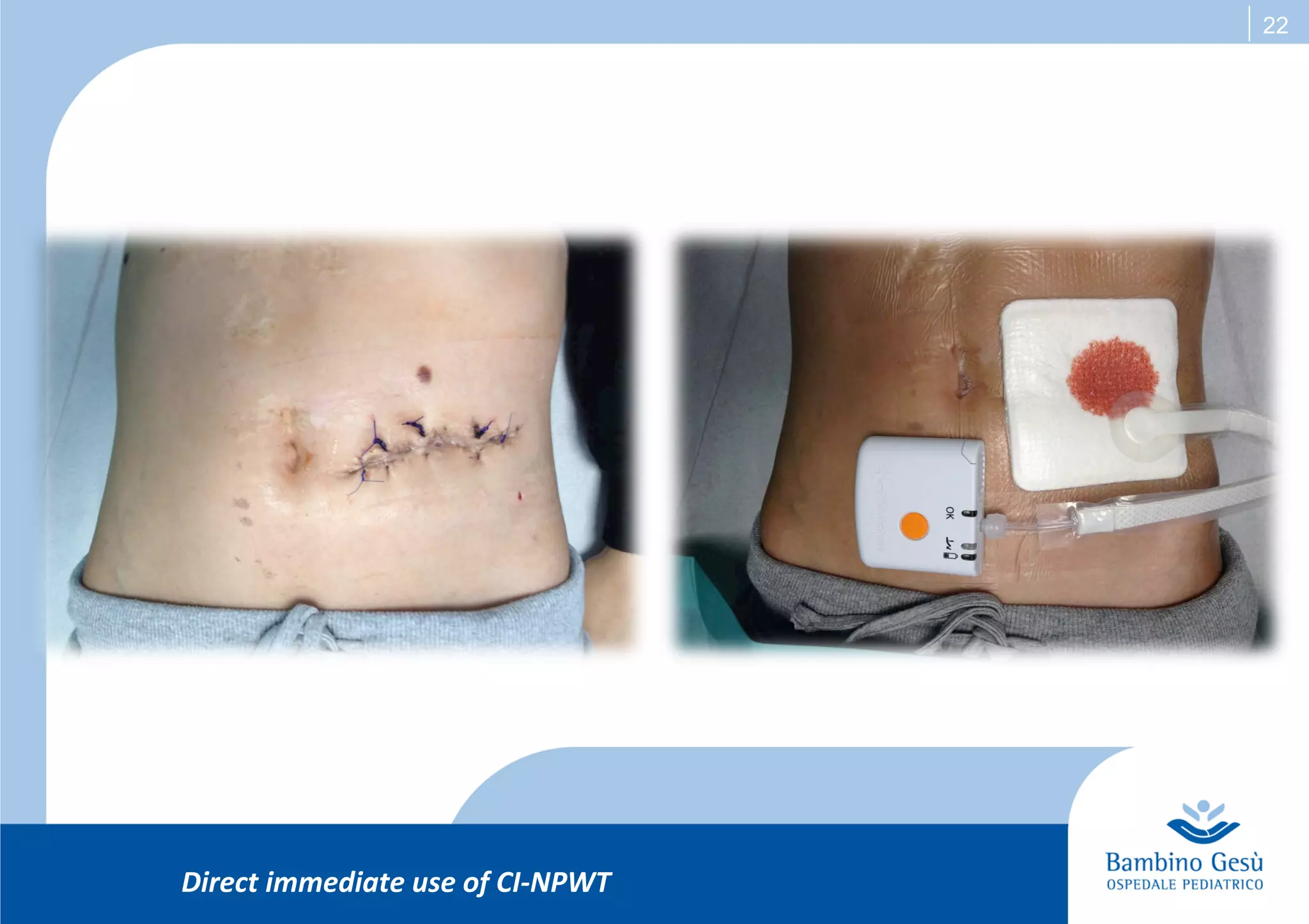 Ciprandi, closed incisional npwt | PDF