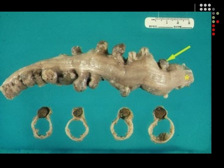 DIVERTICULITIS SIGMOIDEA: CLASIFICACION E INDICACIONES QUIRURGICAS
