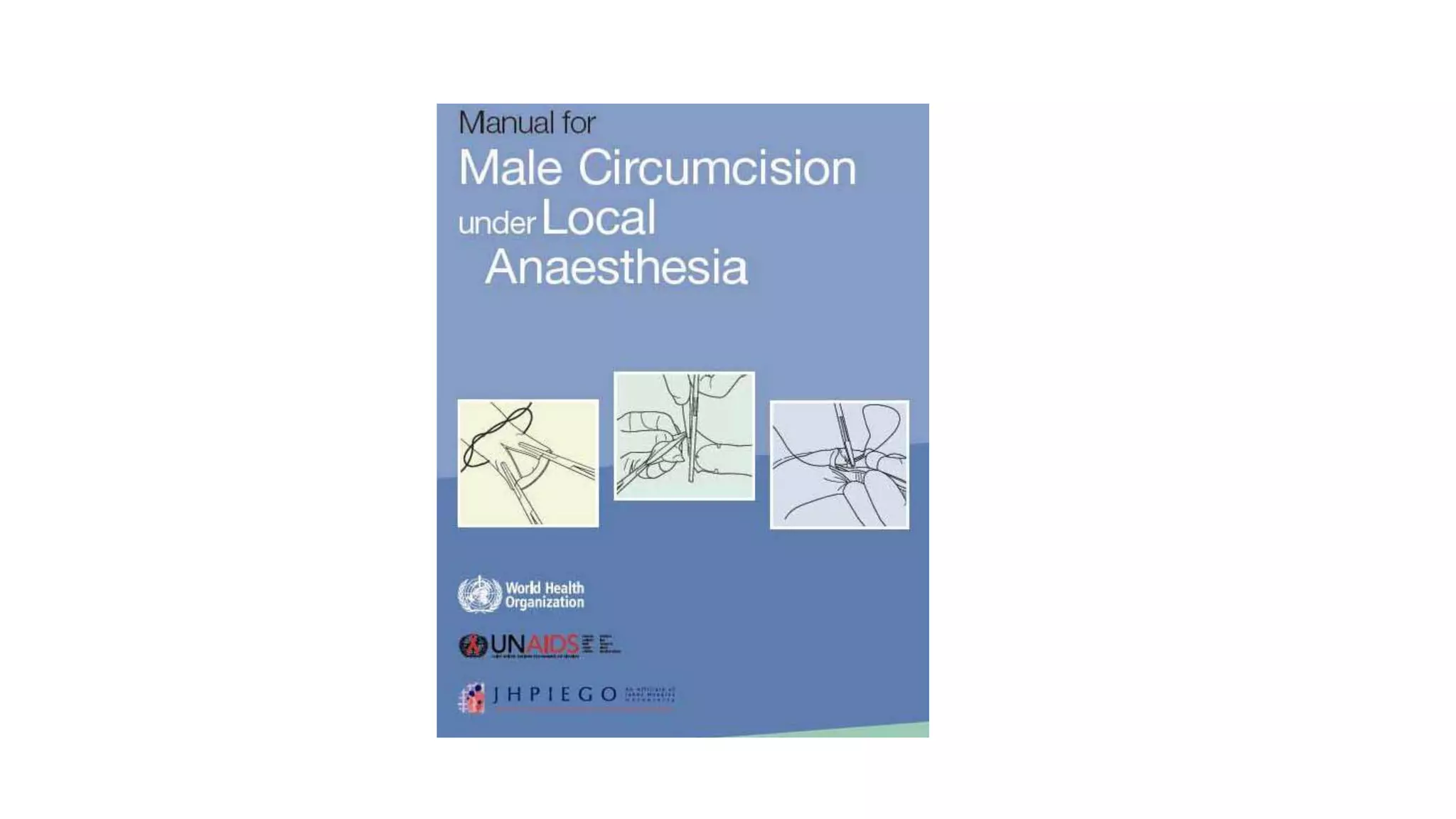 Circumcision Pptx