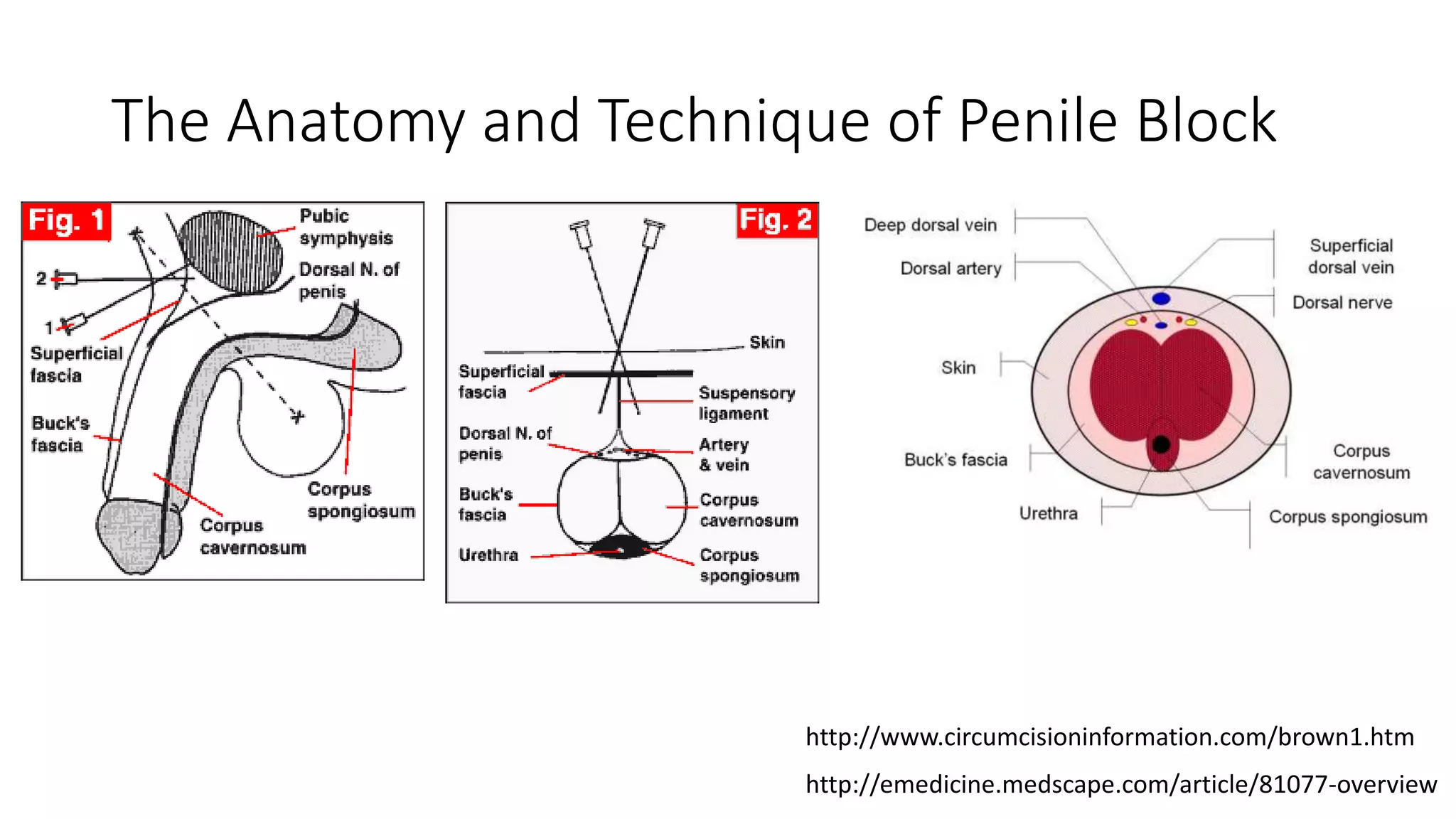 Circumcision | PPTX