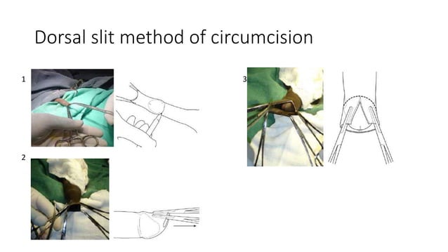 Circumcision | PPT