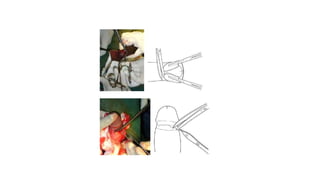 Circumcision | PPTX