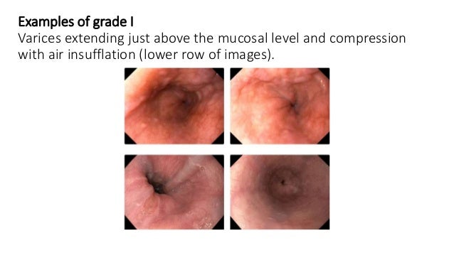 Circulation of liver & Portosystemic collaterals