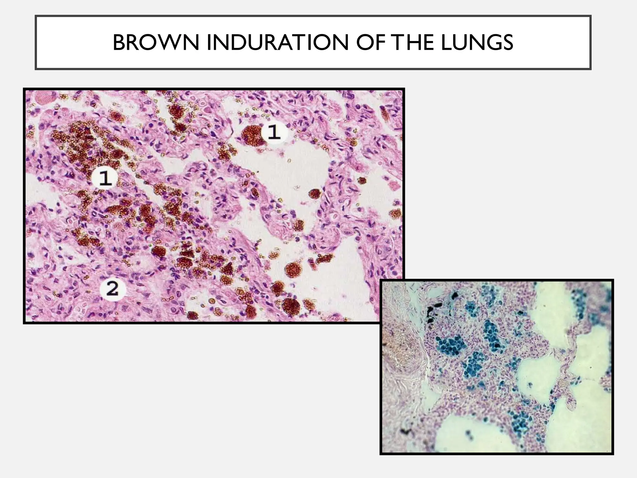 circulatory pathanatomy Congestion, stasis , ischemia, bleeding and ...
