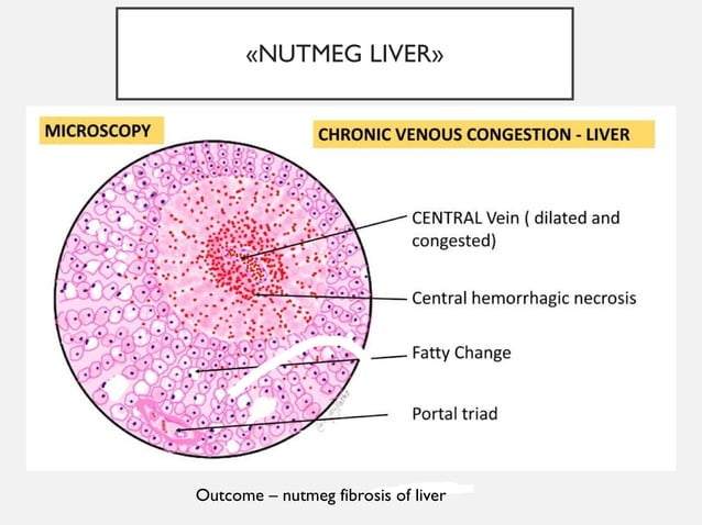 circulatory pathanatomy Congestion, stasis , ischemia, bleeding and ...