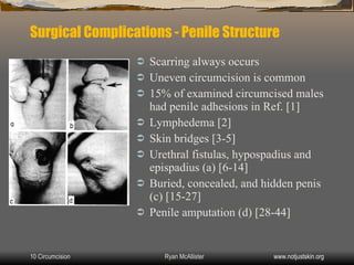 Circumcision | PPT