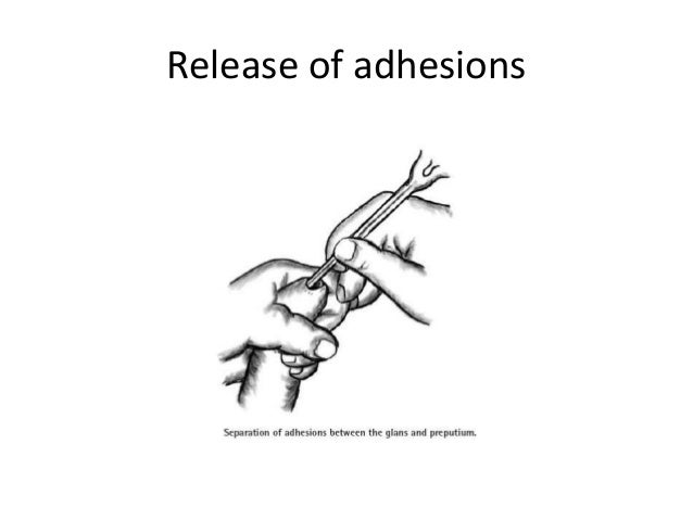 Circumcision