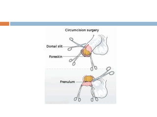 Types Of Circumcision Procedures