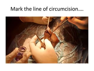 circumcision.pptx