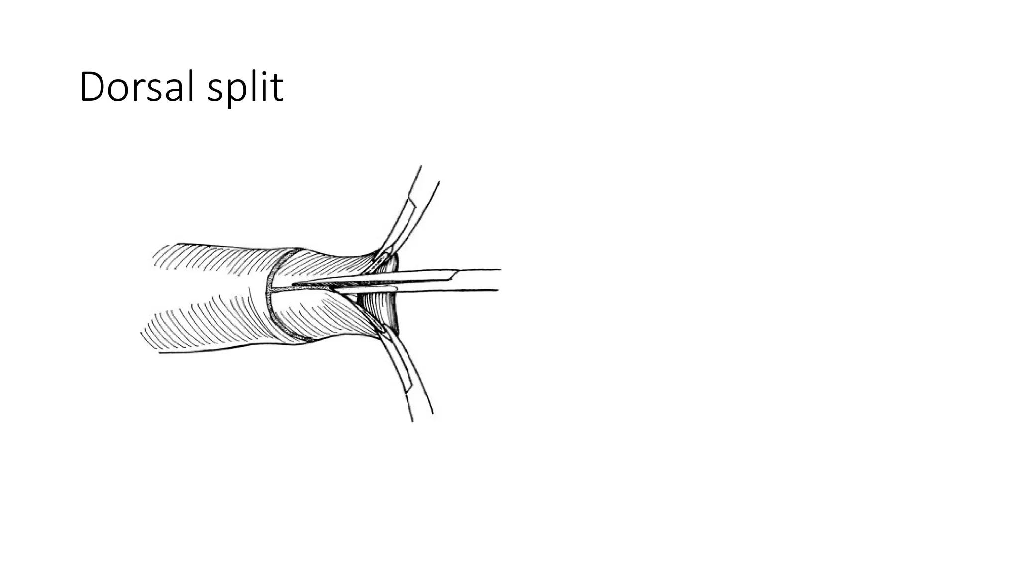 AN OVERVIEW OF CIRCUMCISION AND VARIOUS TYPES | PPTX