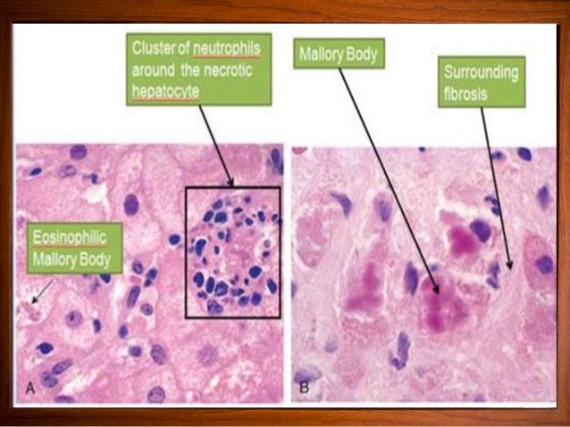Cirrhosis