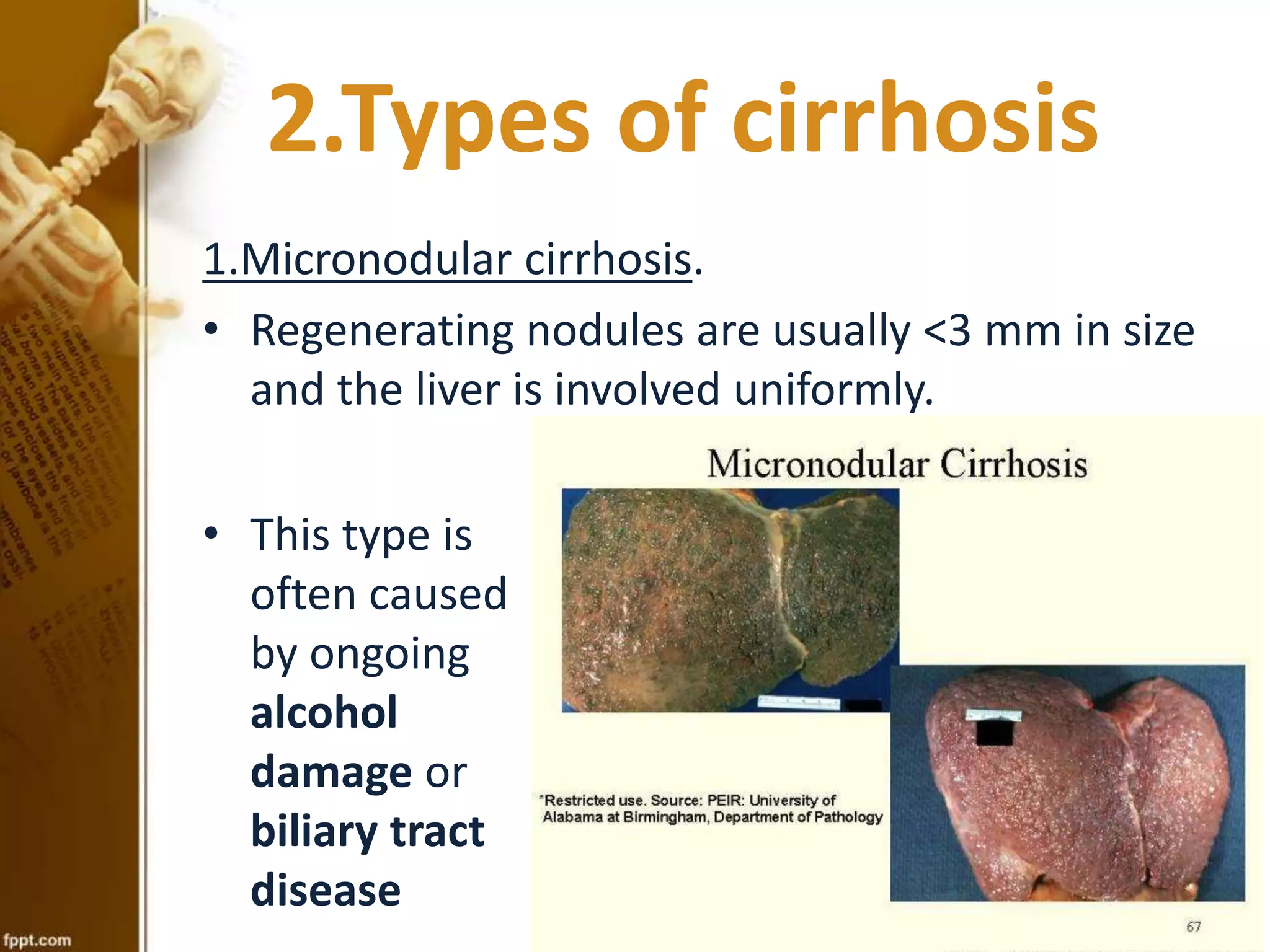 Cirrhosis | PPTX | Digestive Disorders | Diseases and Conditions