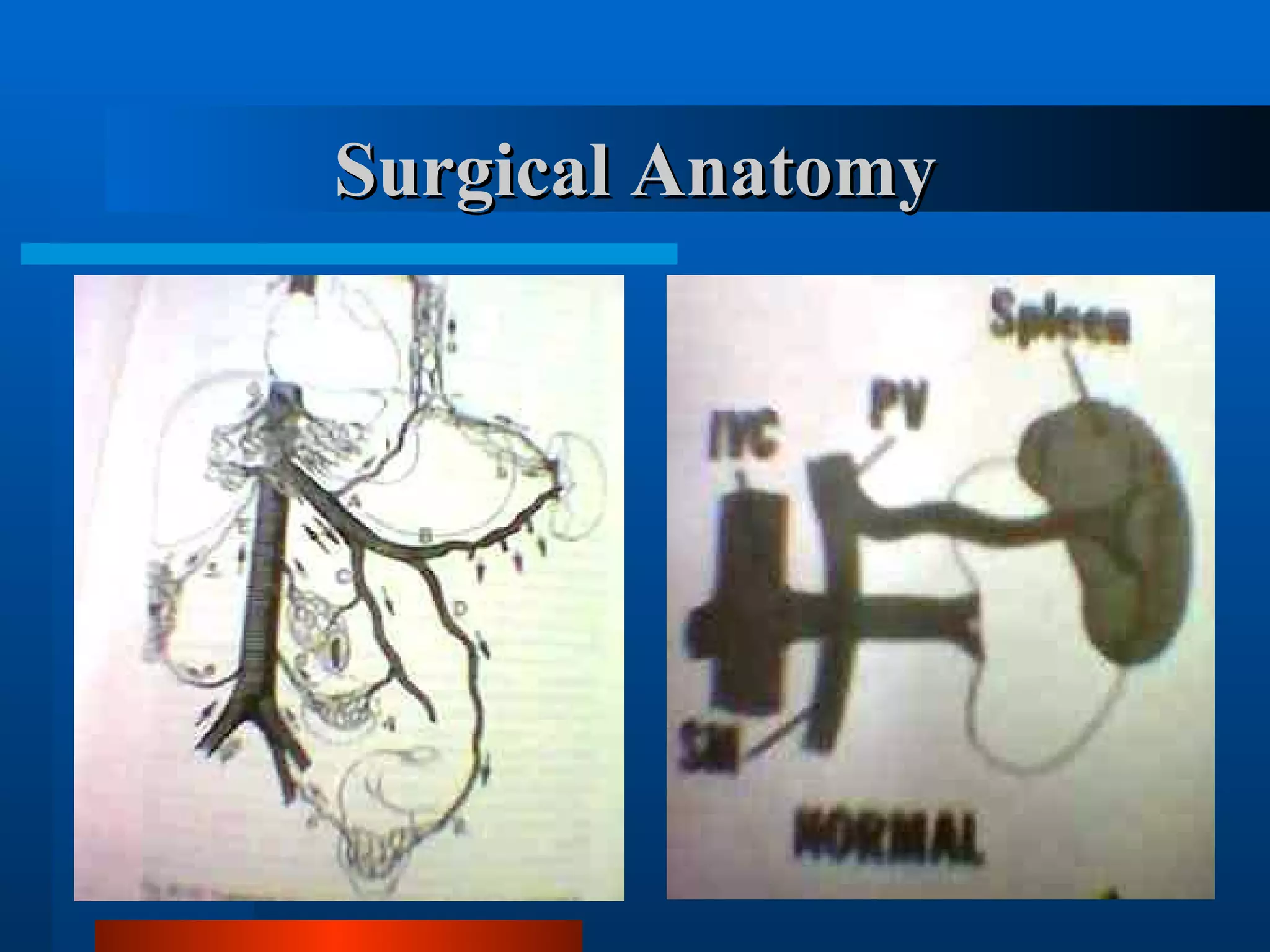 Cirrhosis Complications - Surgical Mx