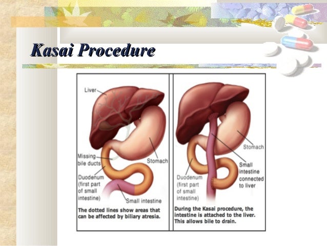 Cirrhosis in children