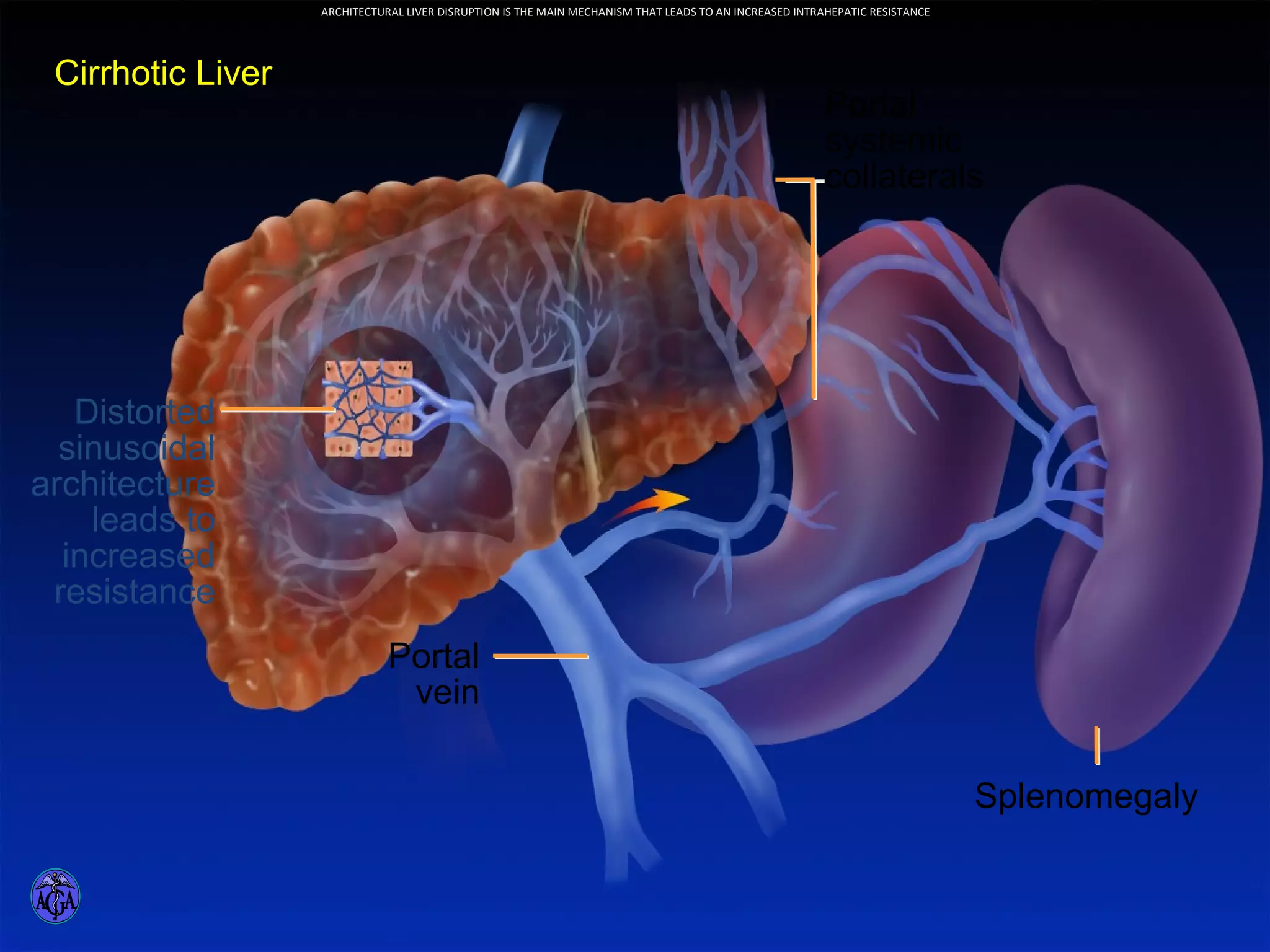 Cirrhosis of liver | PPT