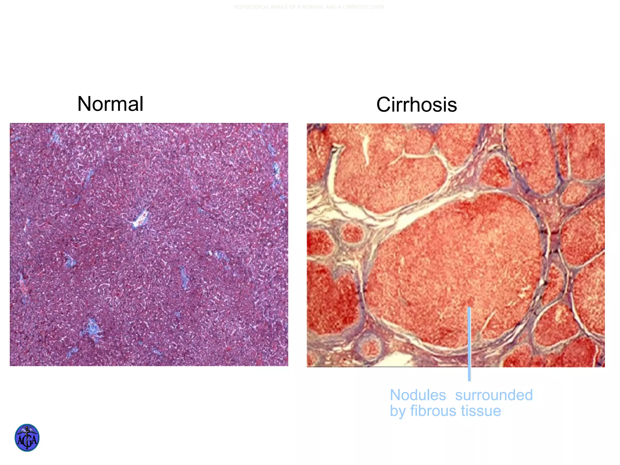 Cirrhosis Of Liver PPT