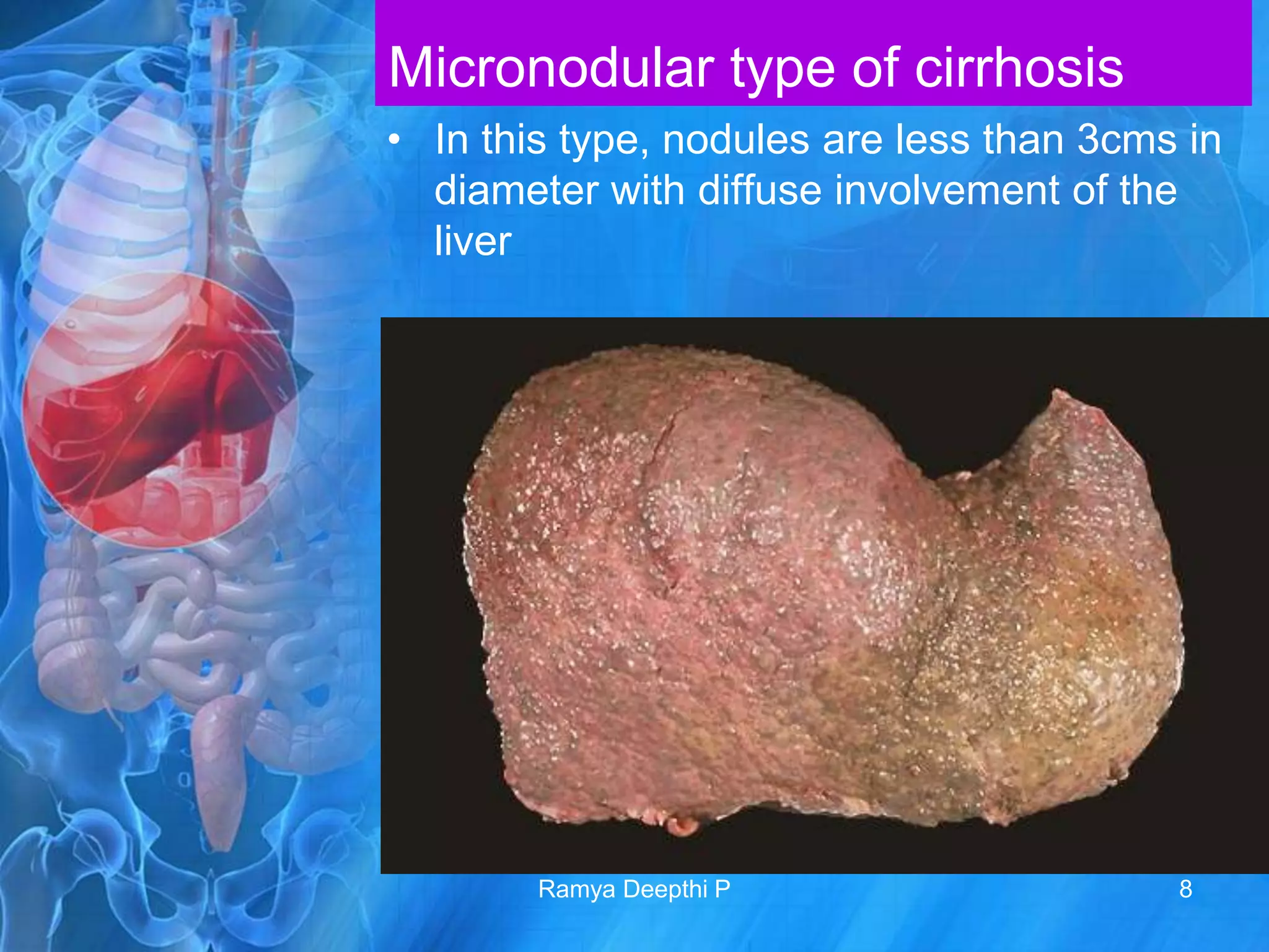 Cirrhosis of liver | PPTX