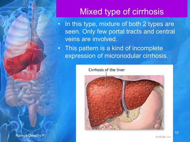 Cirrhosis of liver | PPTX