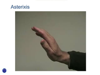 Asterixis Gif