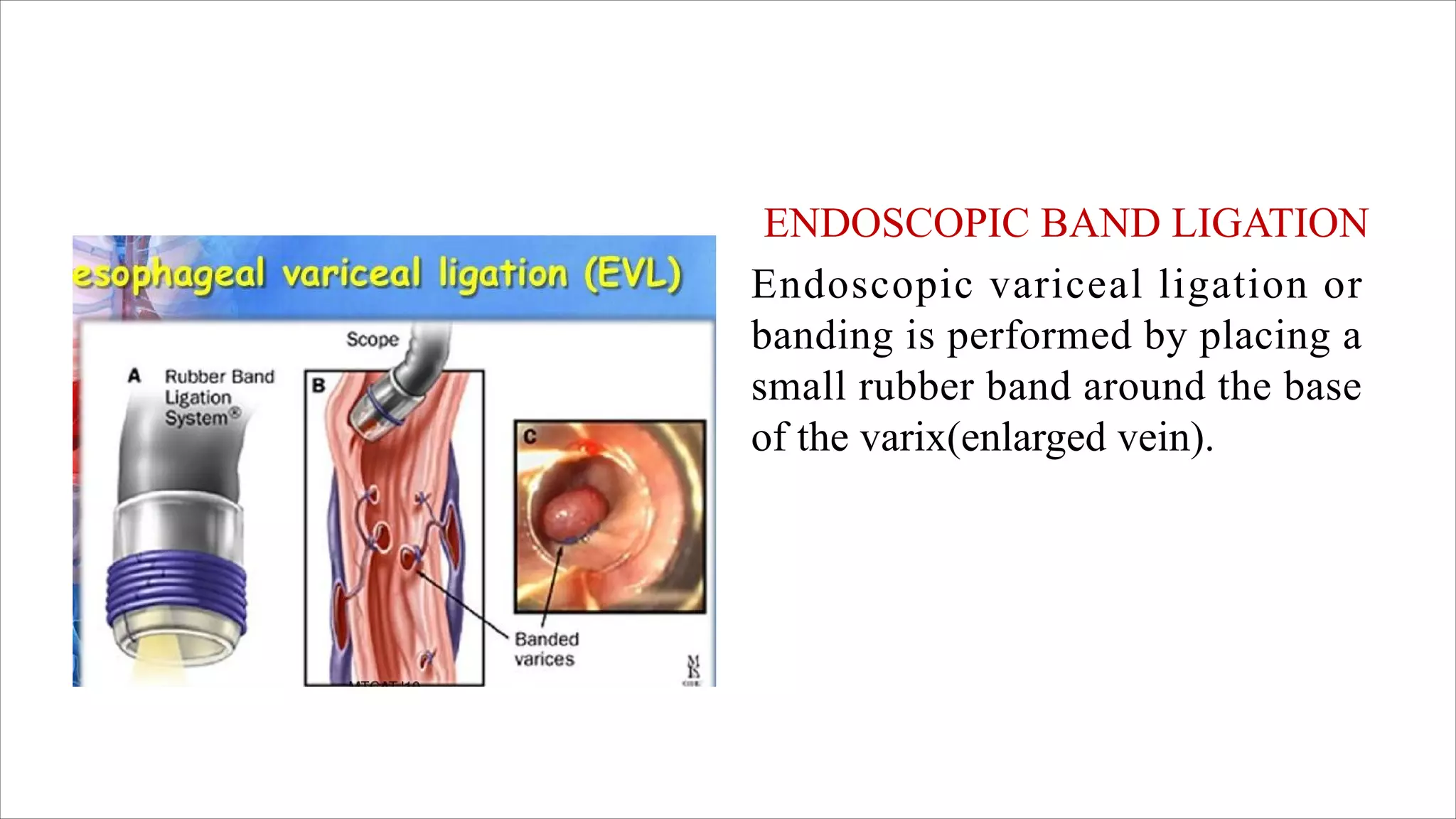 Cirrhosis of liver ppt | PDF
