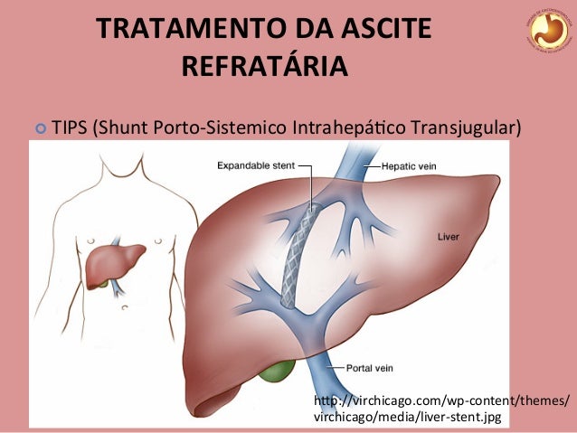 LILIANA MENDES CIRROSE HEPÁTICA E SUAS COMPLICAÇÕES JOVEM GASTRO DF 2…