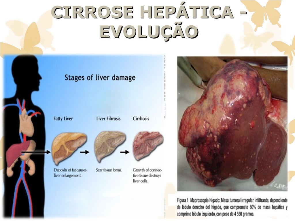 Cirrose Hepática