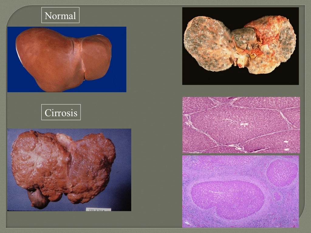 Cirrosis hepatica-sep 2012