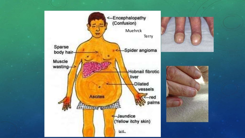 Cirrosis Hepatica