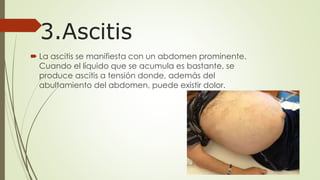 Cirrosis hepatica | PPTX