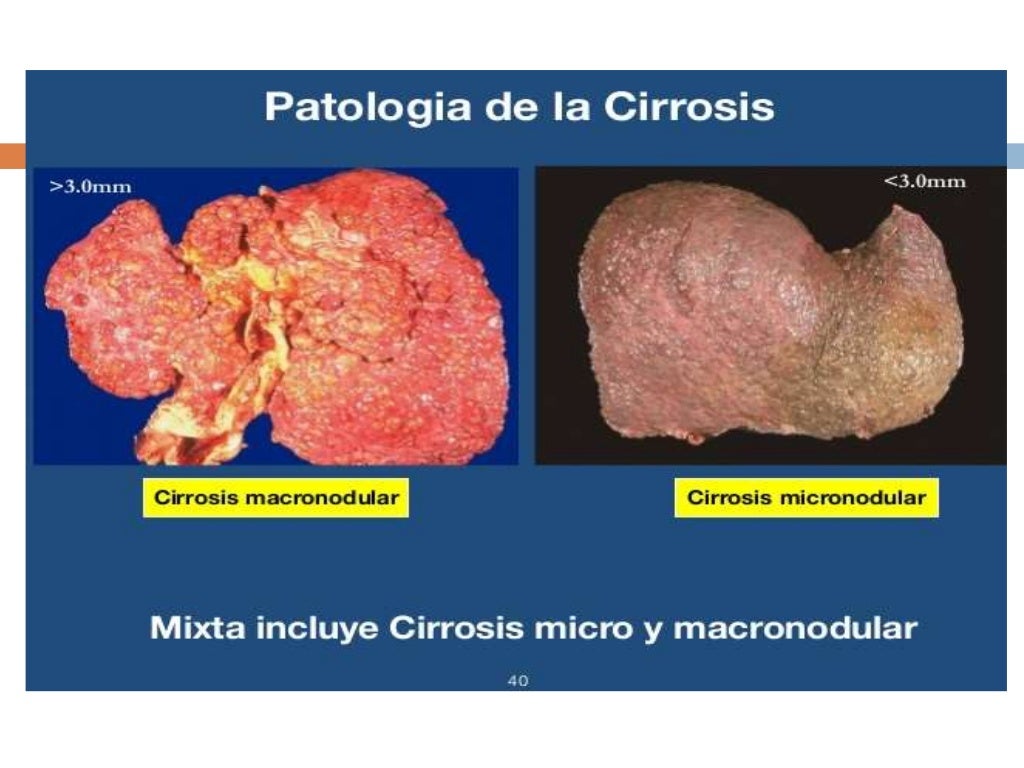 Cirrosis hepatica
